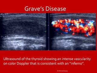Graves Disease Thyroid Ultrasound
