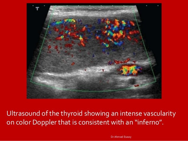thyriod gland imaging part 2 (full story diffuse thyriod disease) Dr