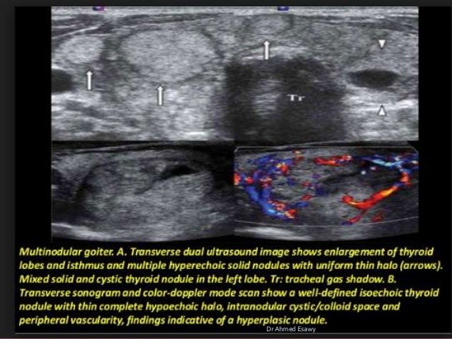 thyriod gland imaging part 2 (full story diffuse thyriod disease) Dr