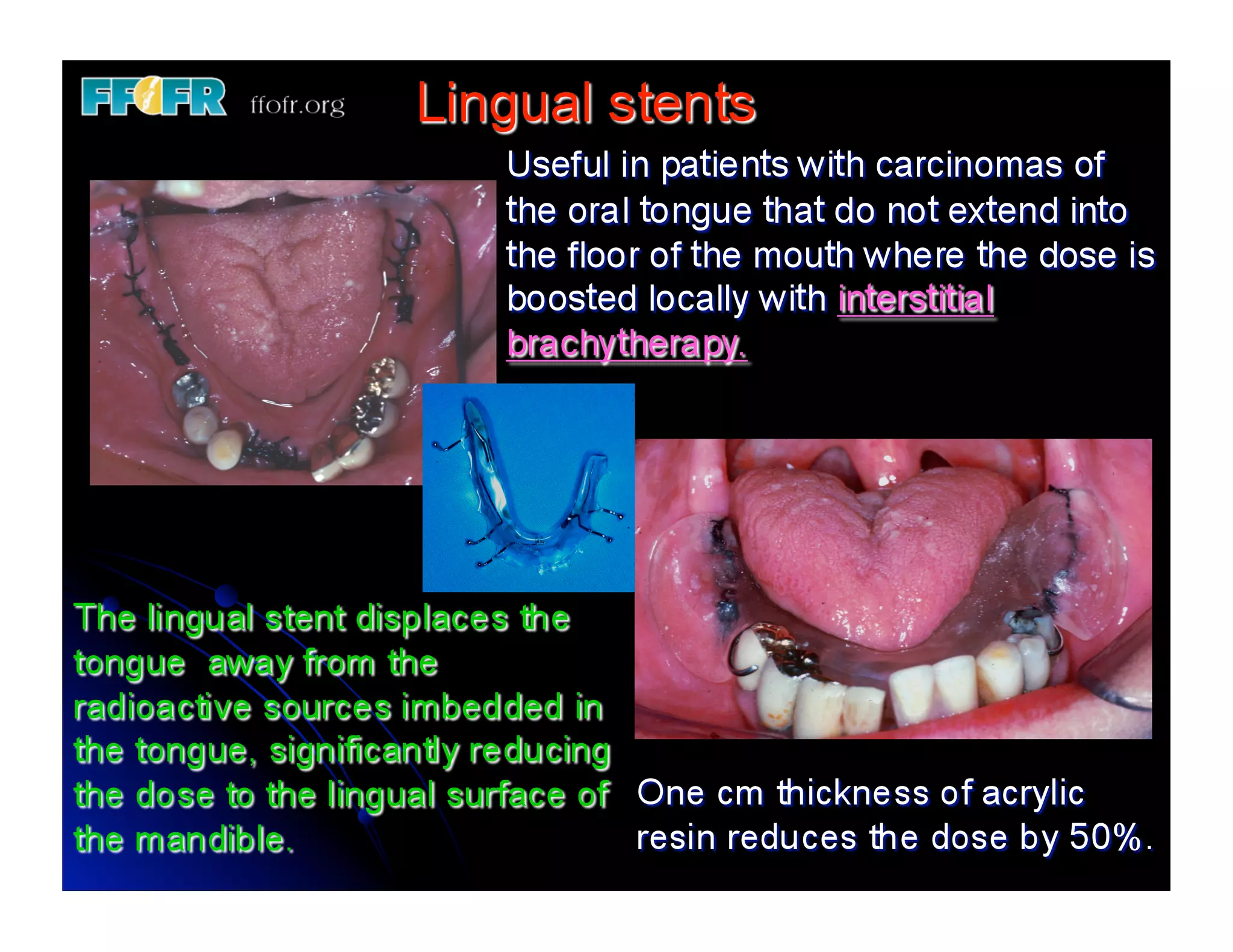 2.use of splints and stents during radiation therapy | PDF