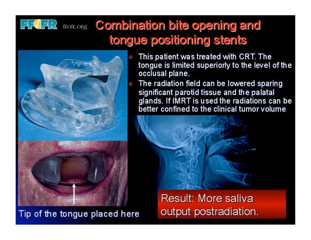 2.use of splints and stents during radiation therapy | PDF