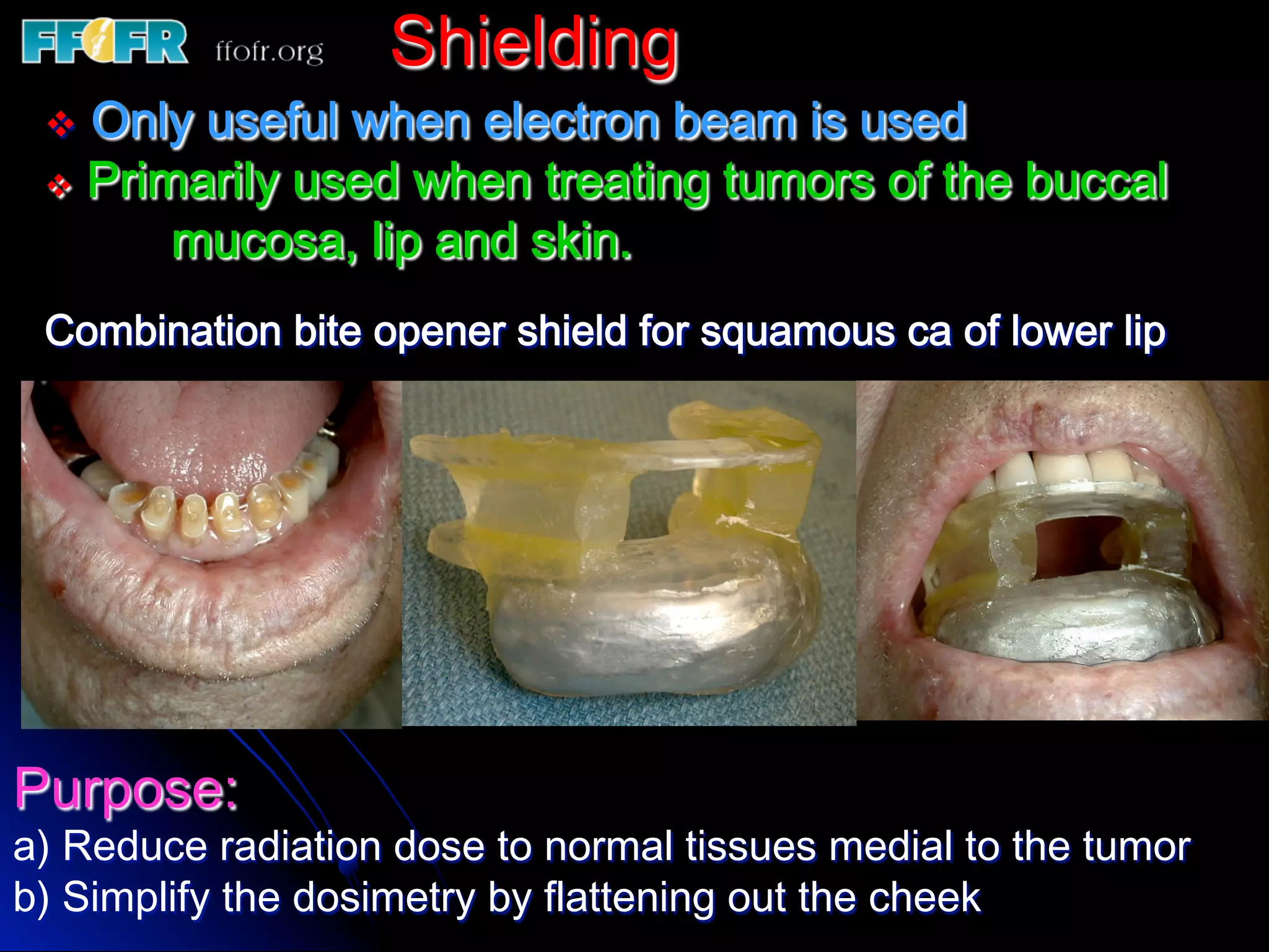 2.use of splints and stents during radiation therapy | PDF