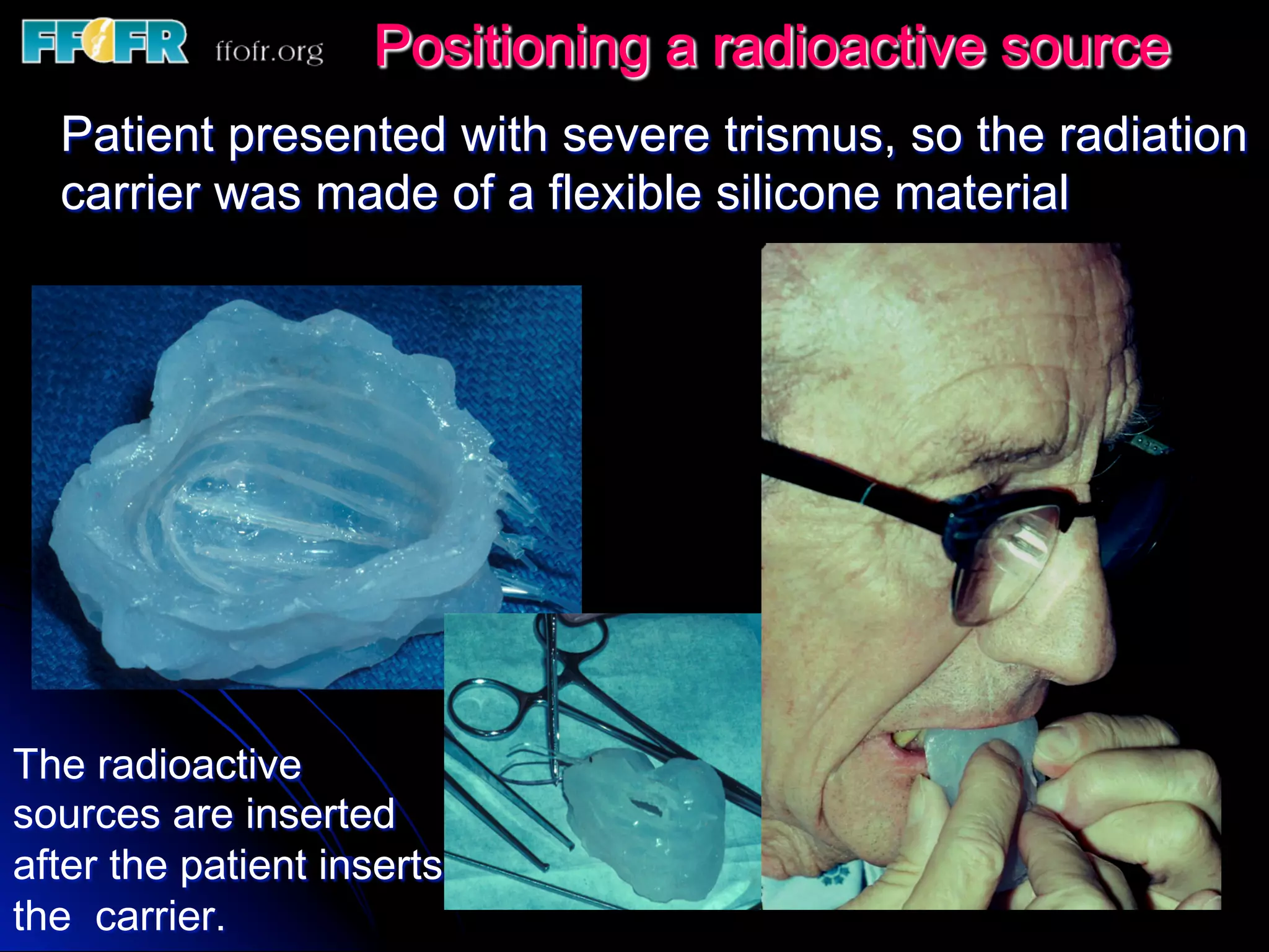 2.use of splints and stents during radiation therapy | PDF