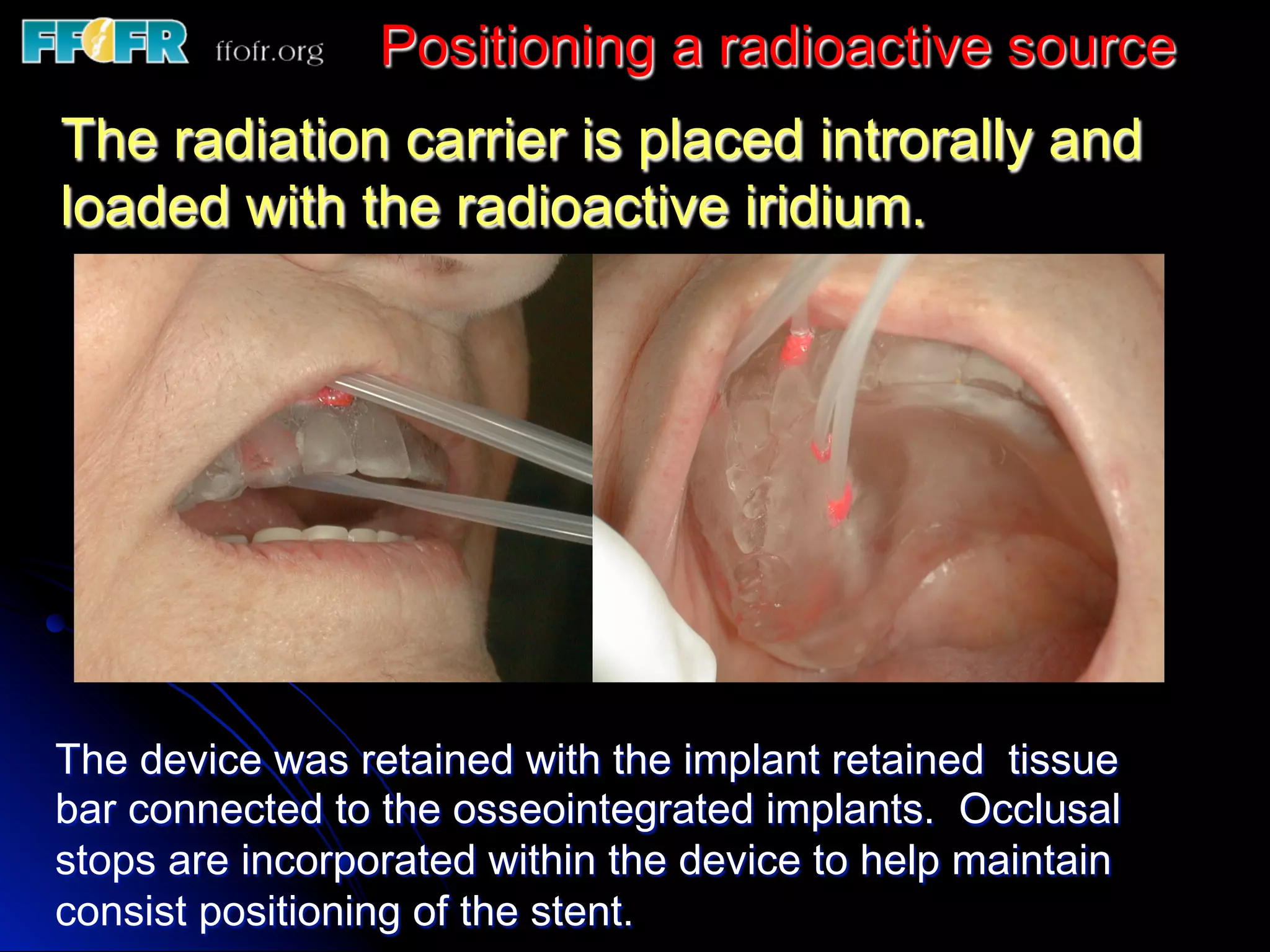 2.use of splints and stents during radiation therapy | PDF