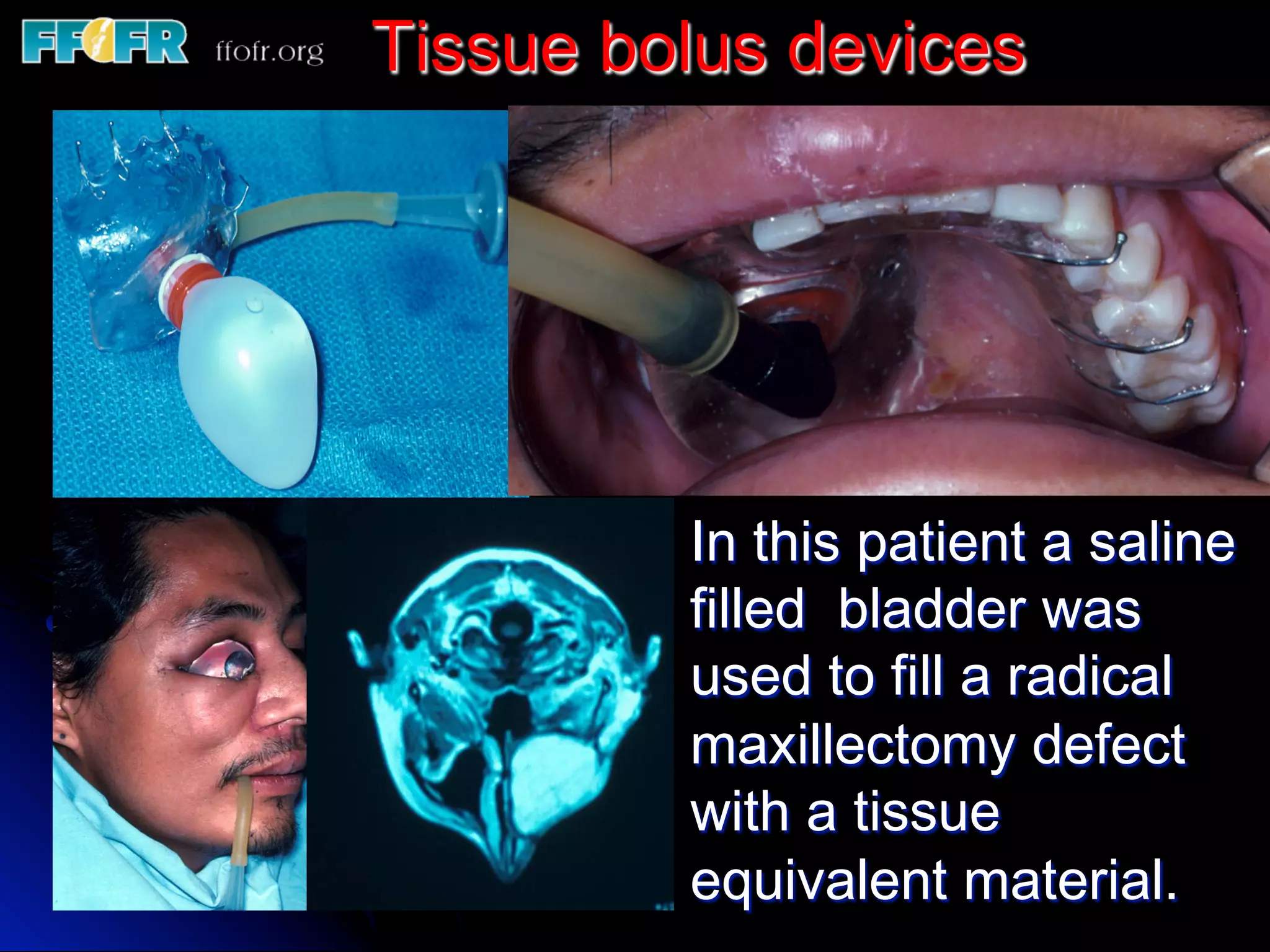 2.use of splints and stents during radiation therapy | PDF