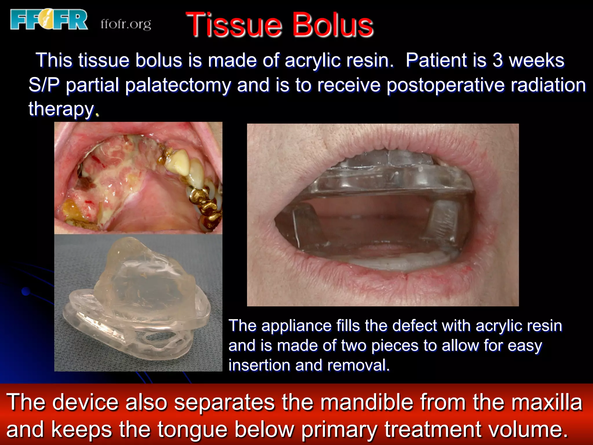 2.use of splints and stents during radiation therapy | PDF