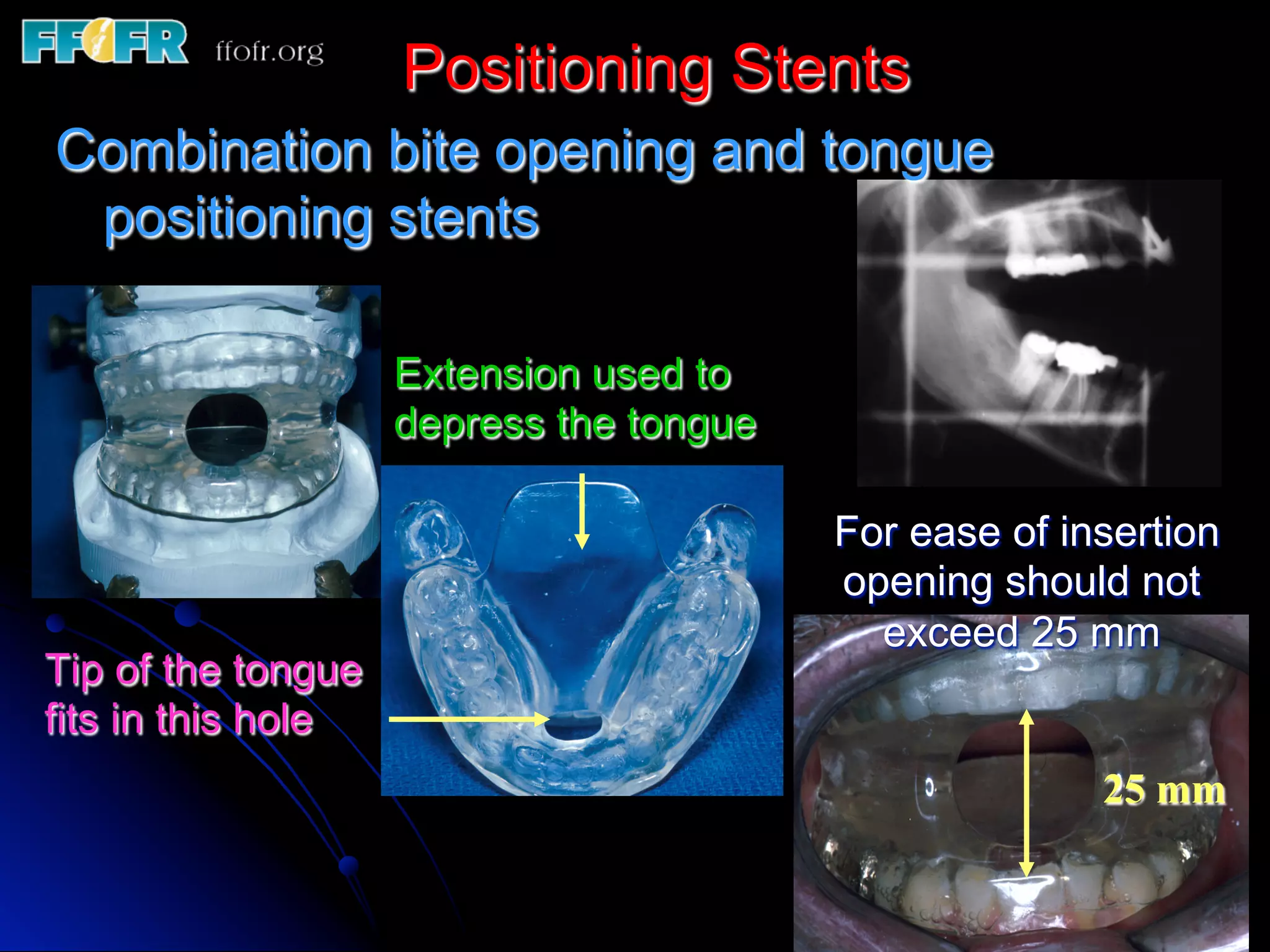 2.use of splints and stents during radiation therapy | PDF