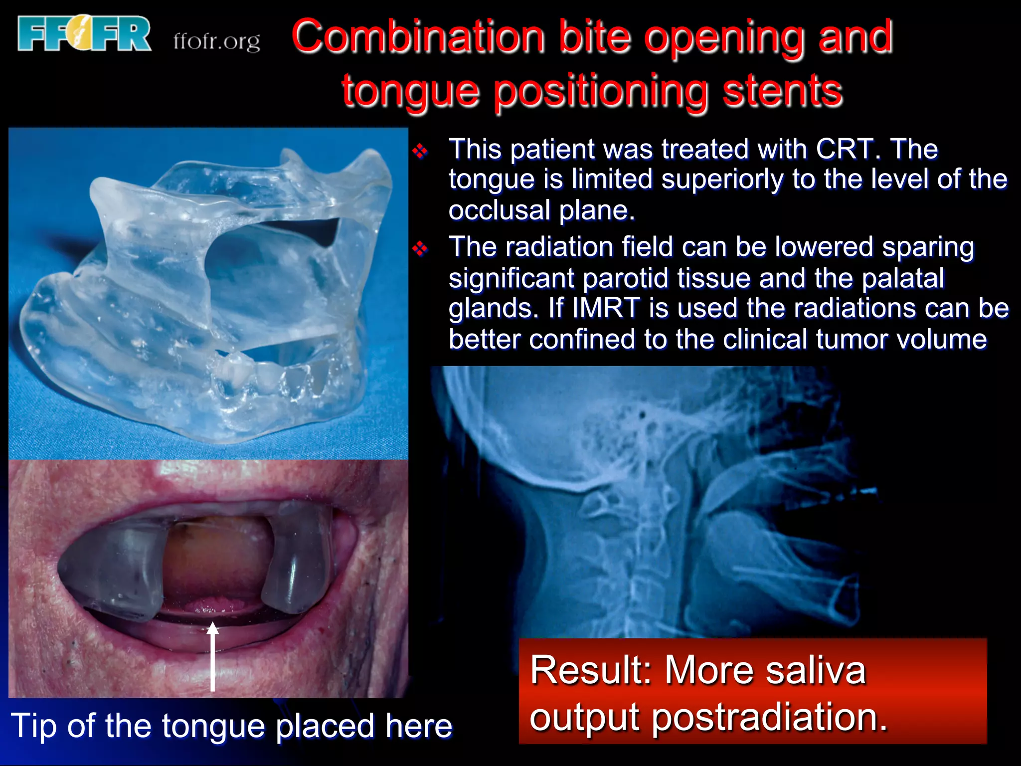2.use of splints and stents during radiation therapy | PDF
