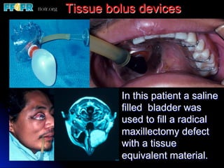 2.use of splints and stents during radiation therapy | PDF