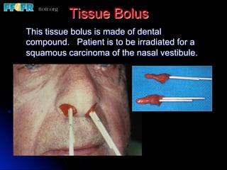 2.use of splints and stents during radiation therapy | PDF