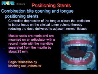 2.use of splints and stents during radiation therapy | PDF