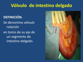 2. vólvulo de intestino delgado | PPT