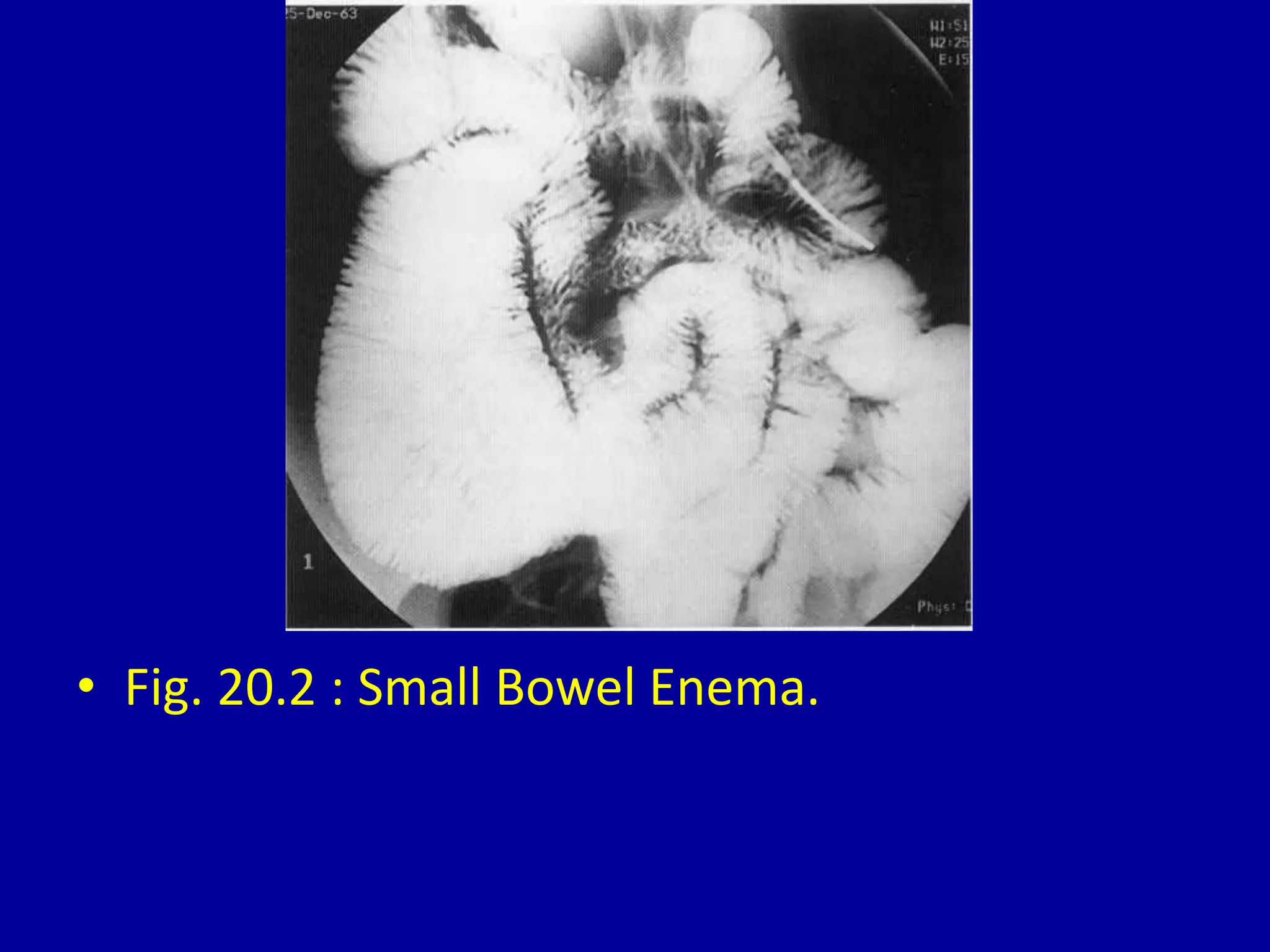 20 DAVID SUTTON PICTURES THE SMALL BOWEL AND PERITONEAL CAVITY | PPTX
