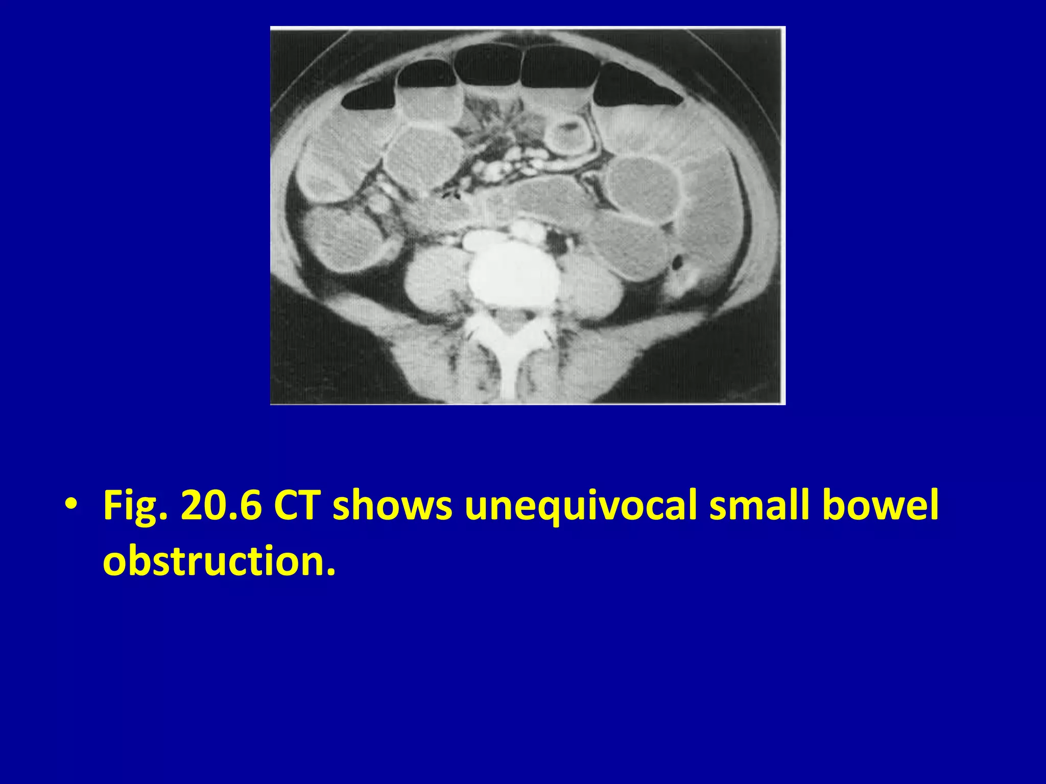 20 DAVID SUTTON PICTURES THE SMALL BOWEL AND PERITONEAL CAVITY | PPTX
