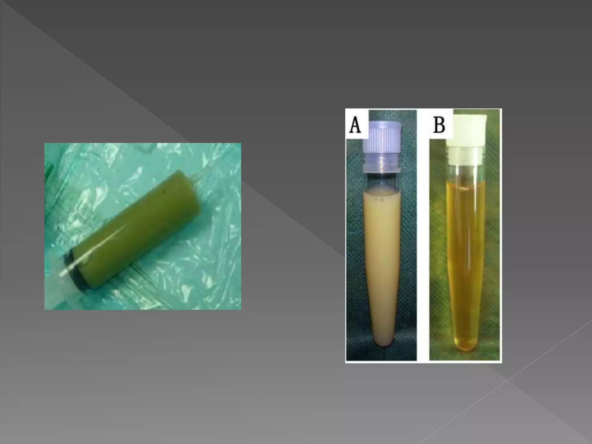 20.5.pleural effusion &empyema | PPTX