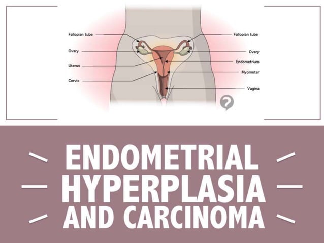 Endometrial hyperplasia and carcinoma | PPTX | Menopause | Endocrine and Metabolic Diseases