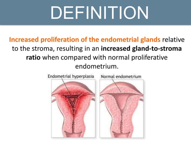 Endometrial hyperplasia and carcinoma | PPTX | Menopause | Endocrine and Metabolic Diseases
