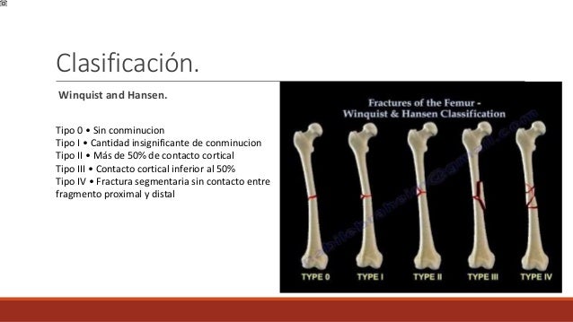 Fracturas diafisiarias femur
