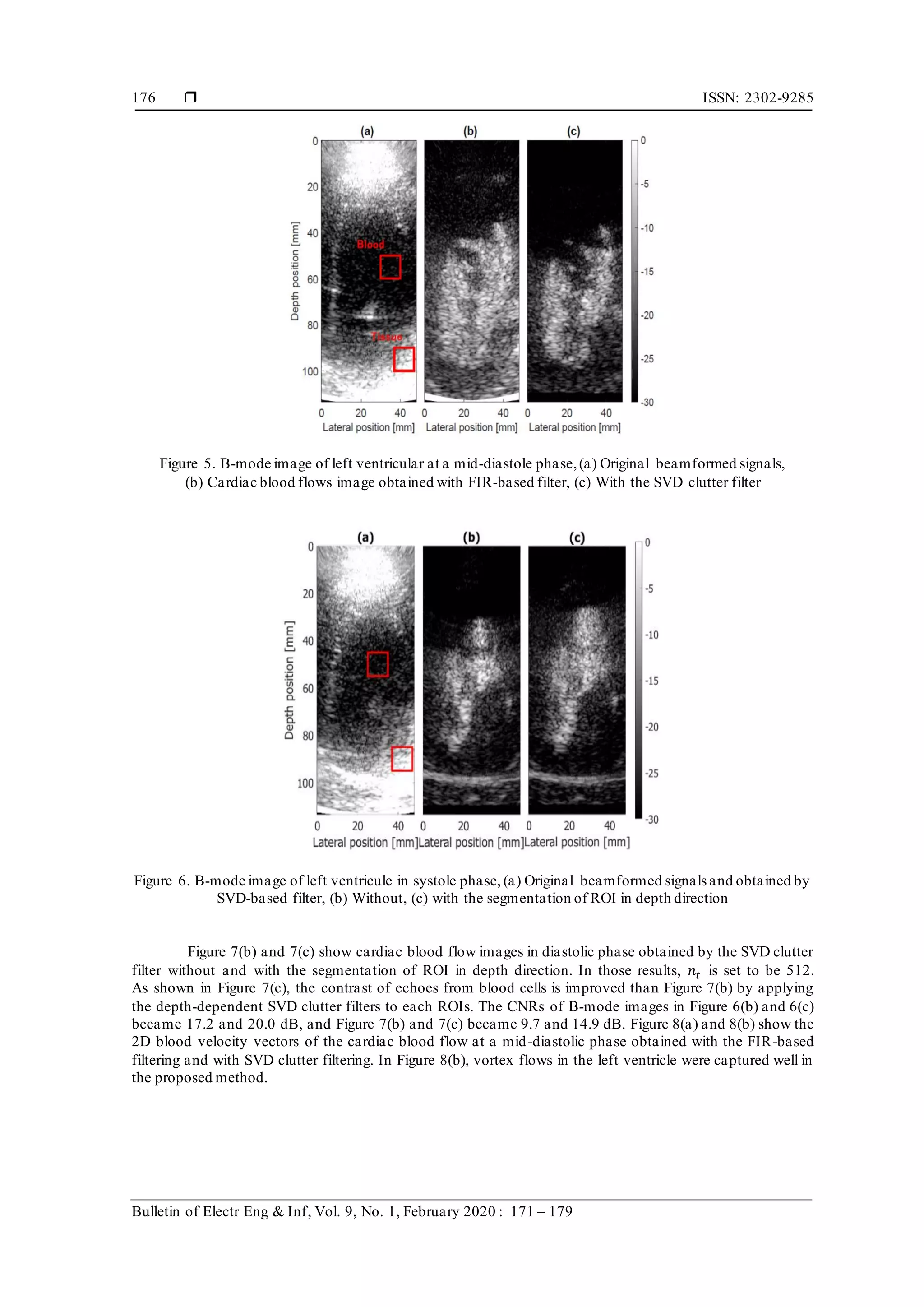 Singular value decomposition filtering in high-frame-rate cardiac ...