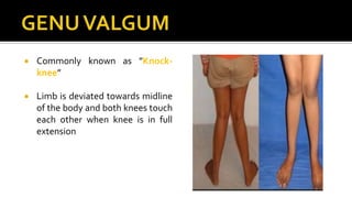 Genu varus and valgus | PPTX