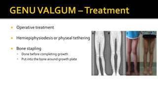 Genu varus and valgus | PPTX