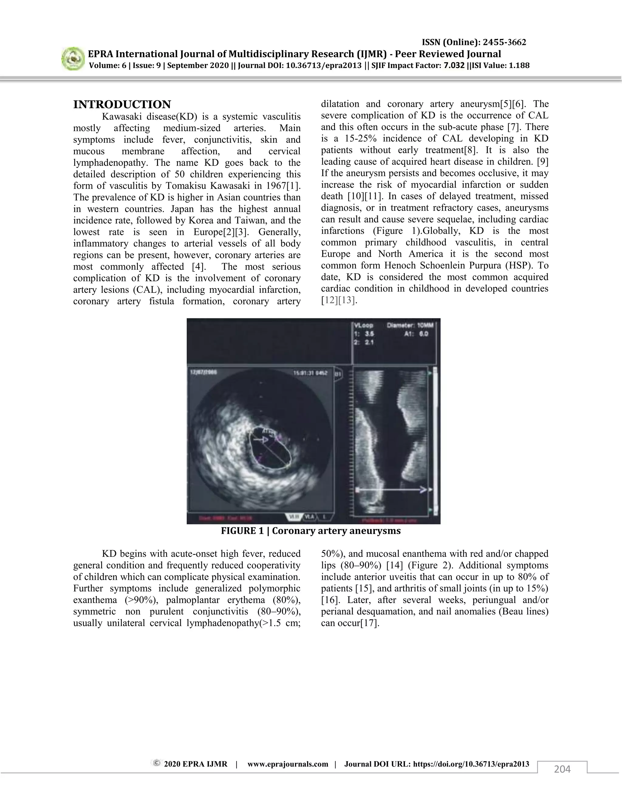 KAWASAKI DISEASE: A CASE REPORT | PDF