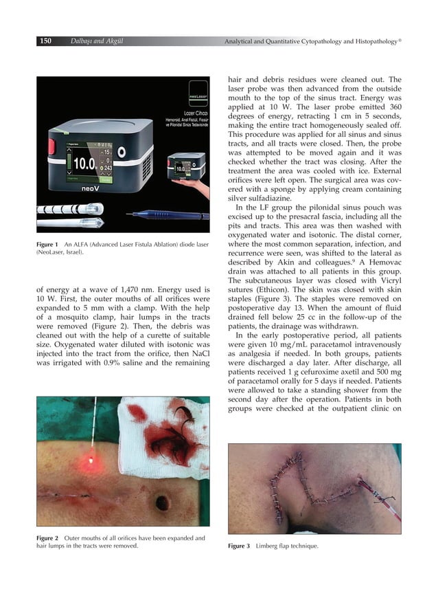 Comparison of Limberg Flap and PiLaT Procedure in Primary Pilonidal ...