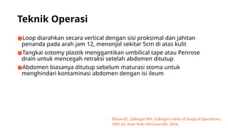 Intestinal stoma powerpoint illeostomy colostomy | PPTX