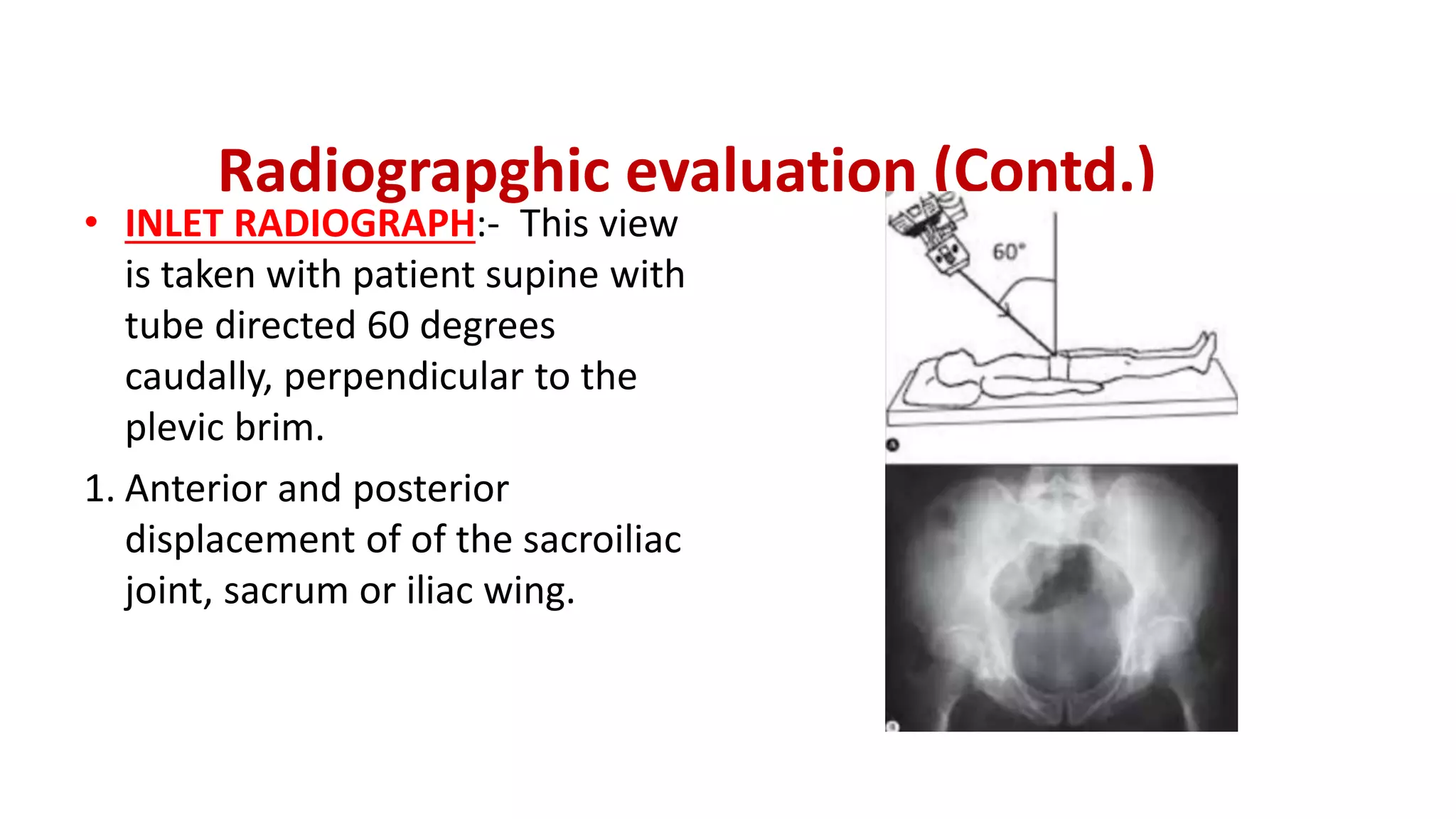 classification of pelvic fracture | PPTX