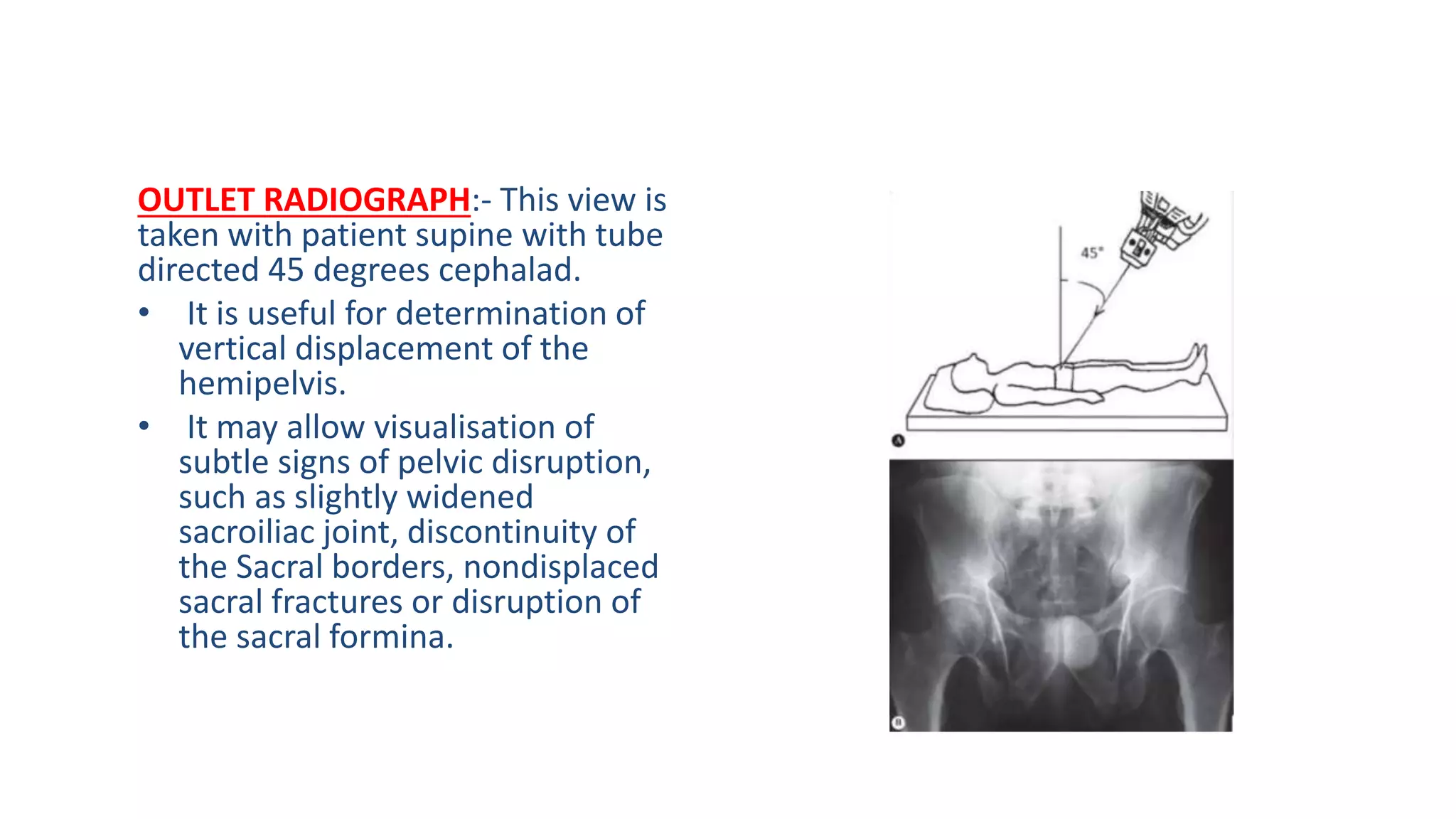 classification of pelvic fracture | PPTX