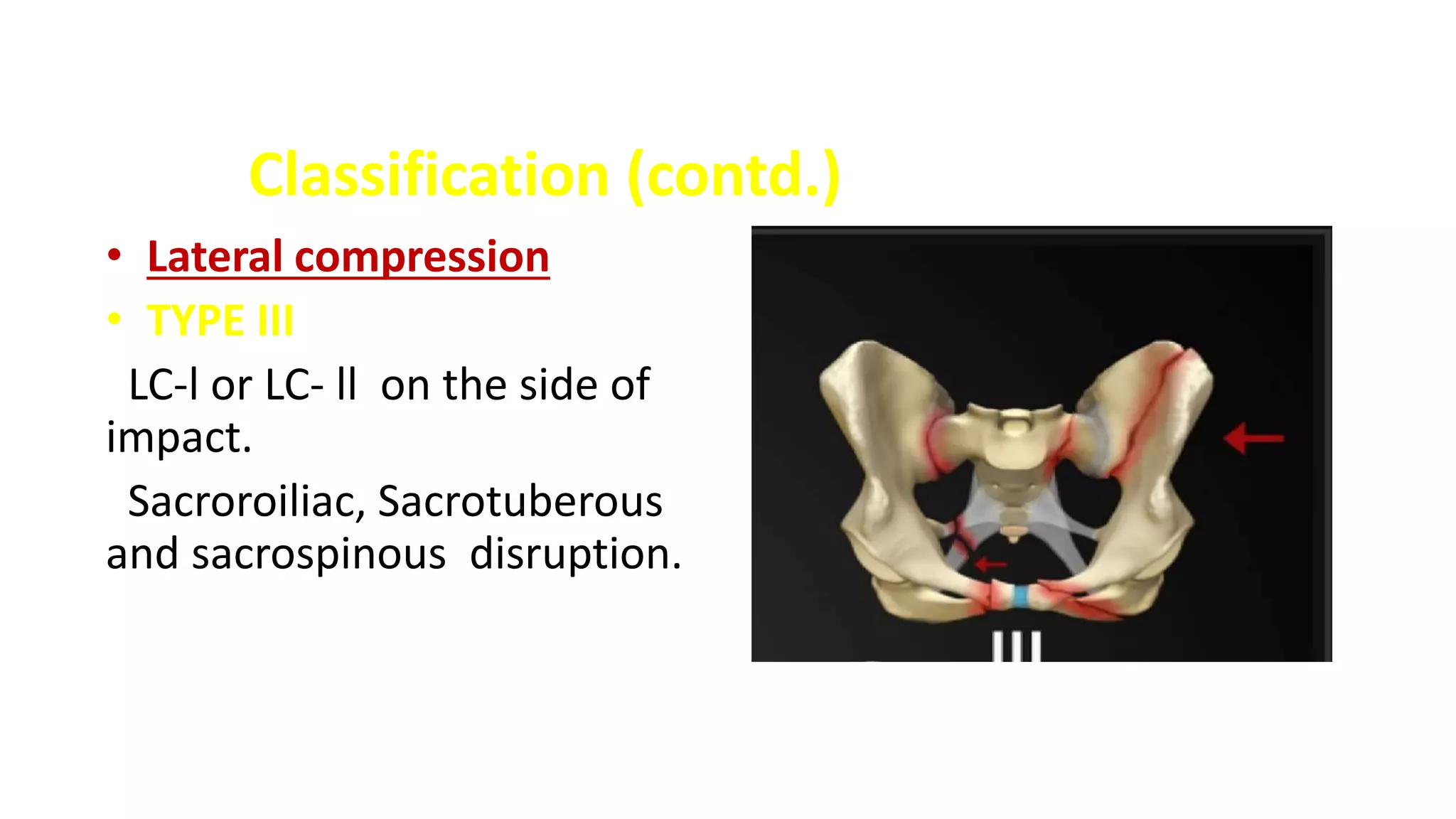 classification of pelvic fracture | PPTX