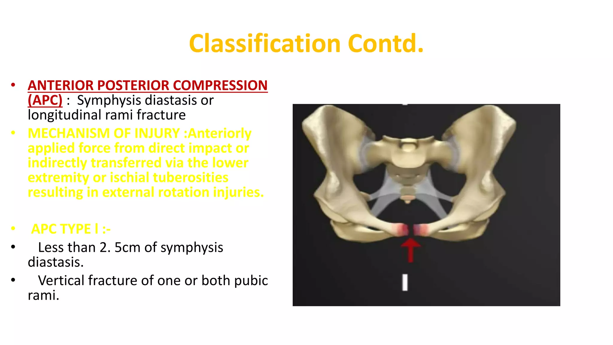 classification of pelvic fracture | PPTX