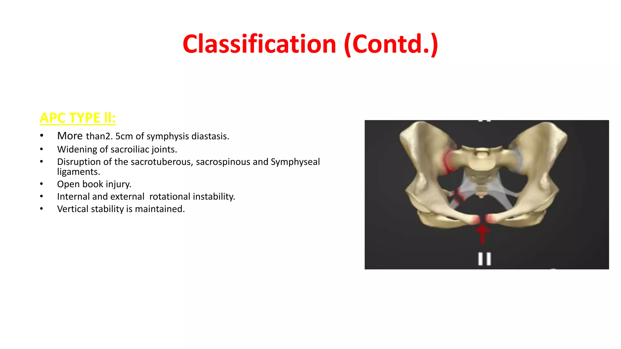classification of pelvic fracture | PPTX