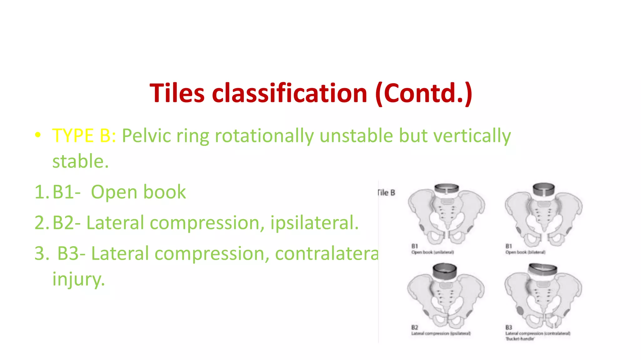 classification of pelvic fracture | PPTX