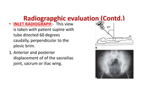 classification of pelvic fracture | PPTX