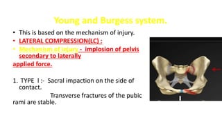 classification of pelvic fracture | PPTX