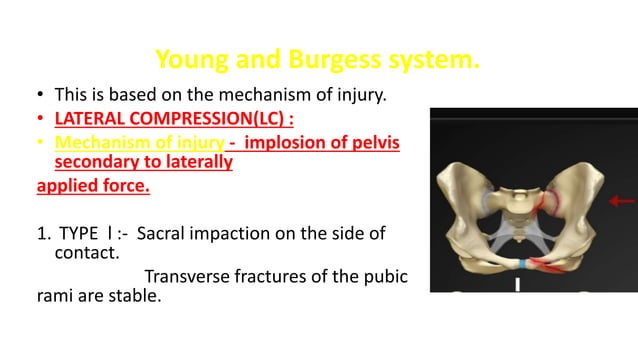 classification of pelvic fracture | PPTX