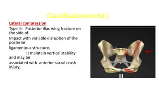 classification of pelvic fracture | PPTX