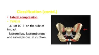 classification of pelvic fracture | PPTX