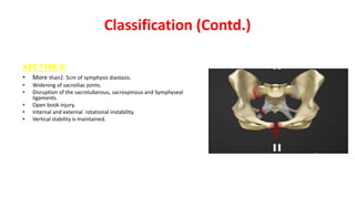 classification of pelvic fracture | PPTX