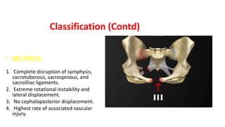 classification of pelvic fracture | PPTX