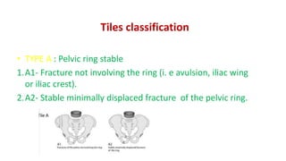 classification of pelvic fracture | PPTX