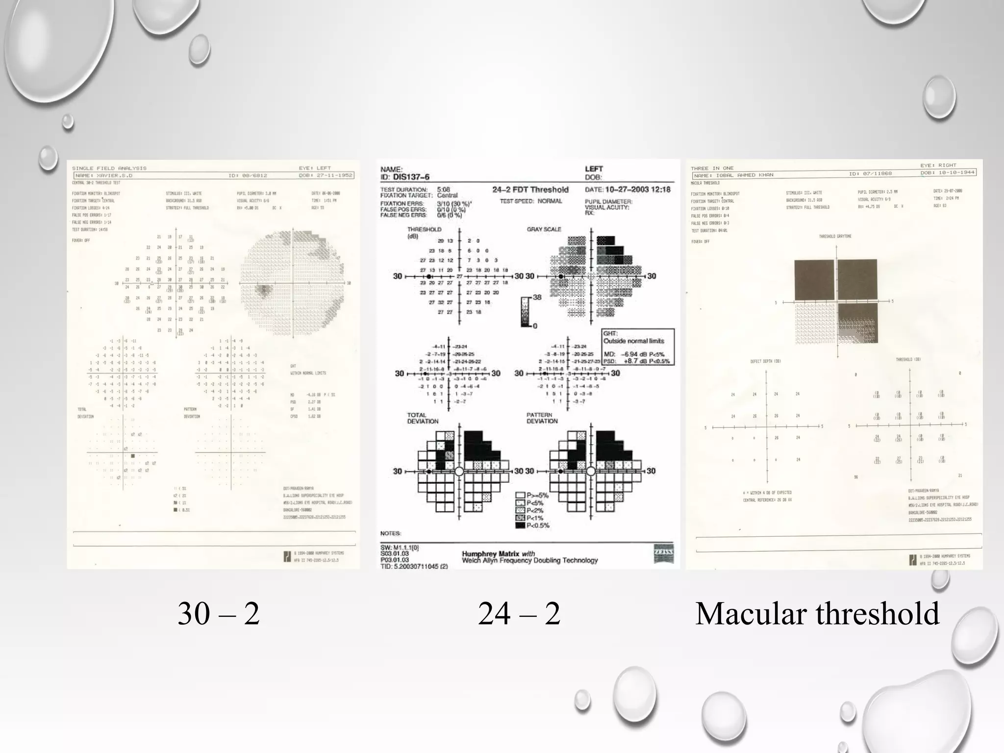 Automated-perimetry - Brief review and basics | PPT