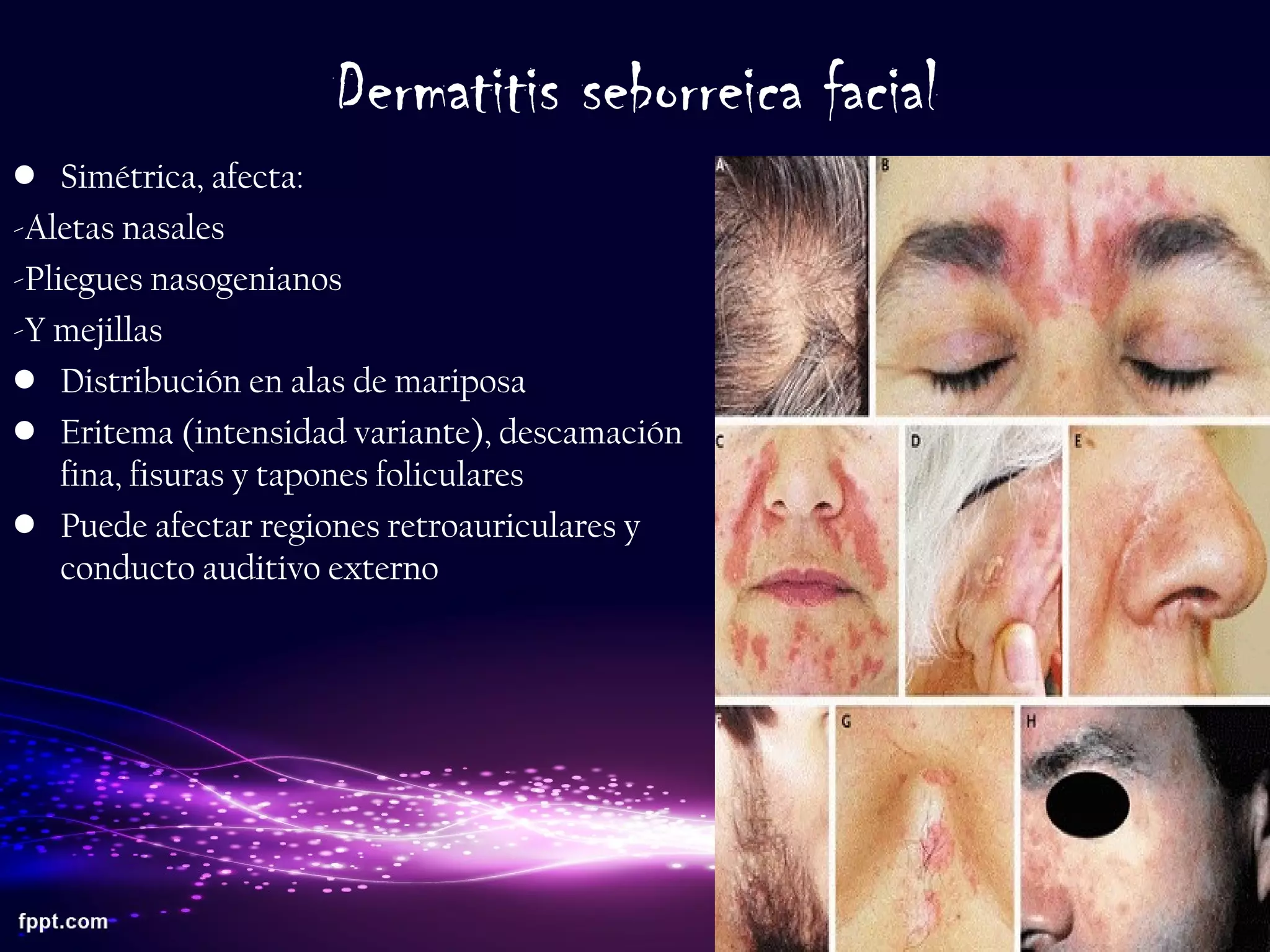 dermatitis seborreica, acne vulgar y rosacea | PPT