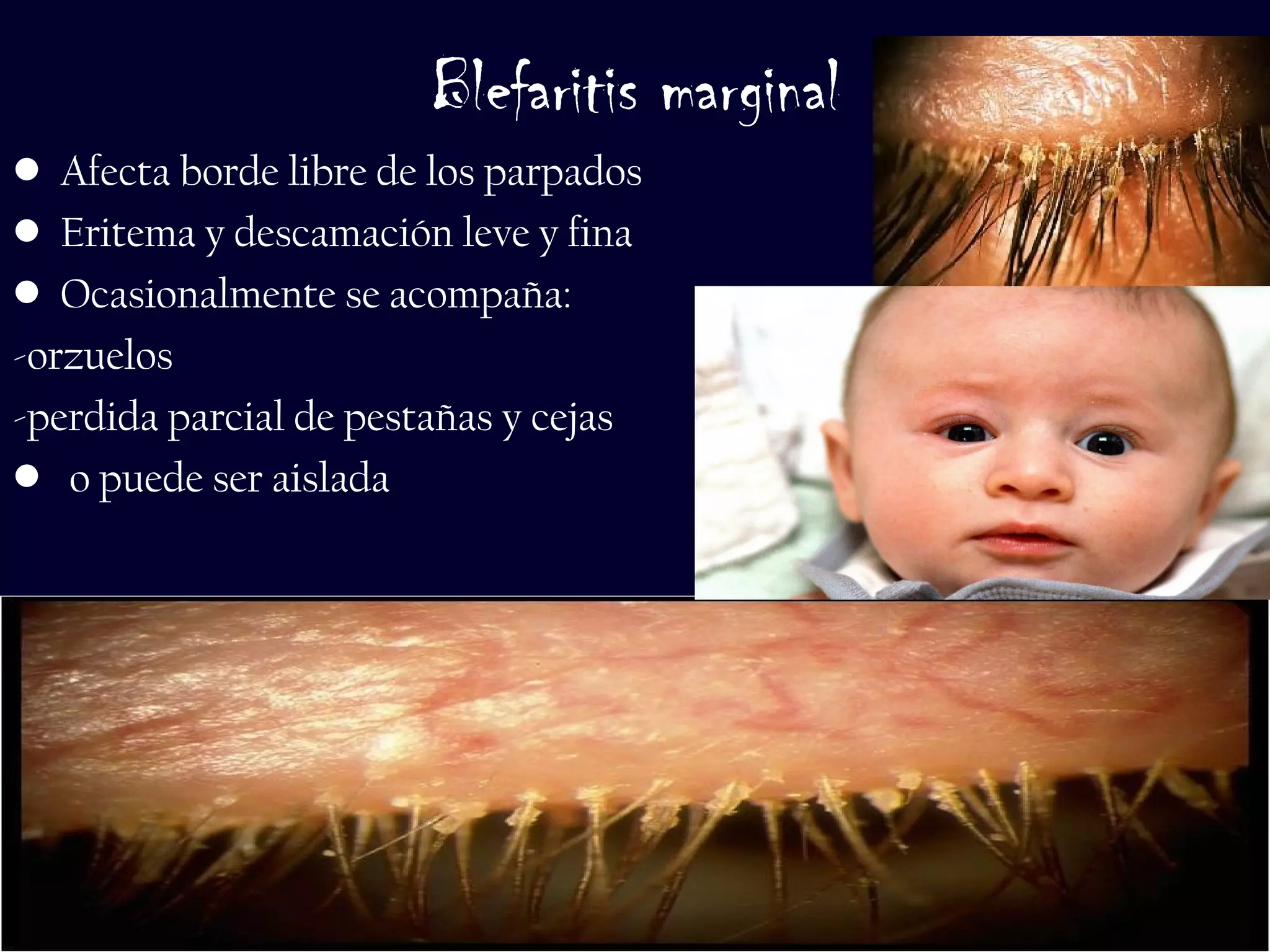 dermatitis seborreica, acne vulgar y rosacea | PPT