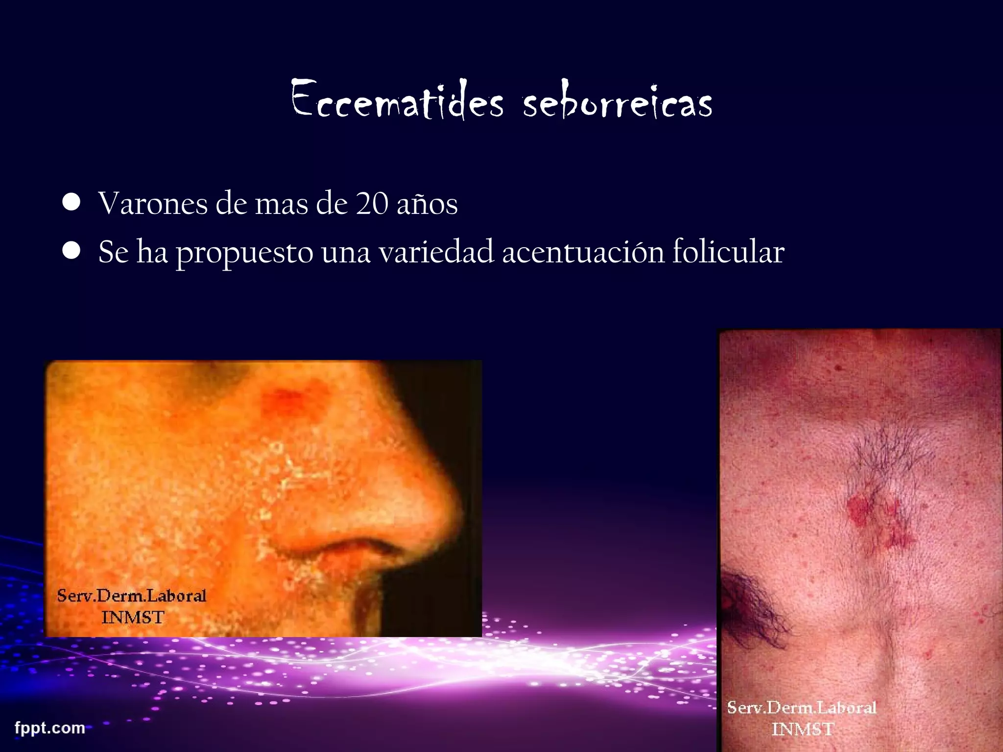 dermatitis seborreica, acne vulgar y rosacea | PPT | Skin and ...