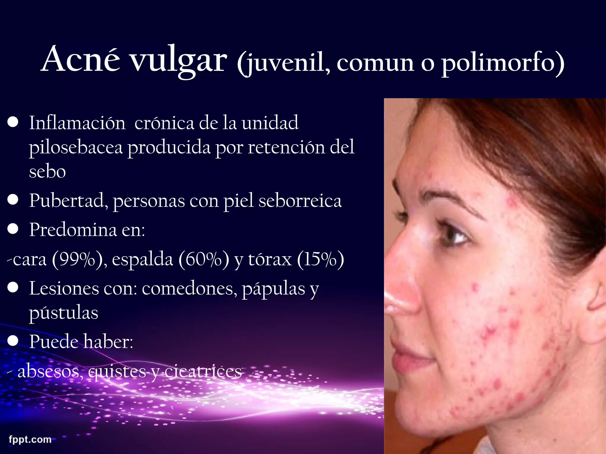 dermatitis seborreica, acne vulgar y rosacea | PPT | Skin and ...