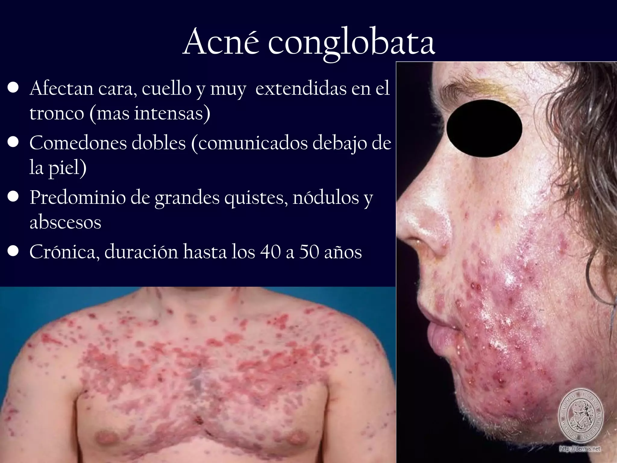 dermatitis seborreica, acne vulgar y rosacea | PPT | Skin and ...