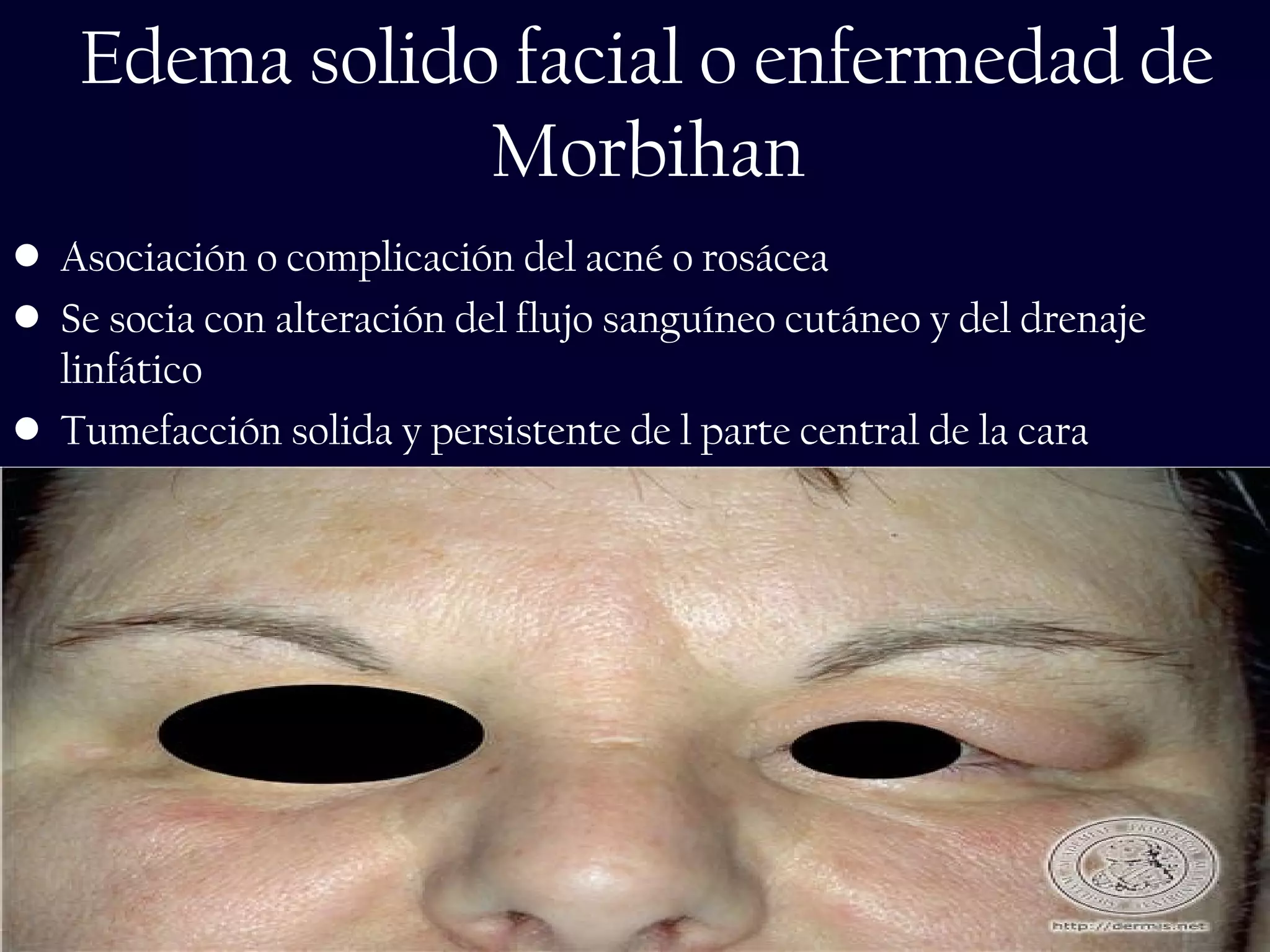 dermatitis seborreica, acne vulgar y rosacea | PPT | Skin and ...