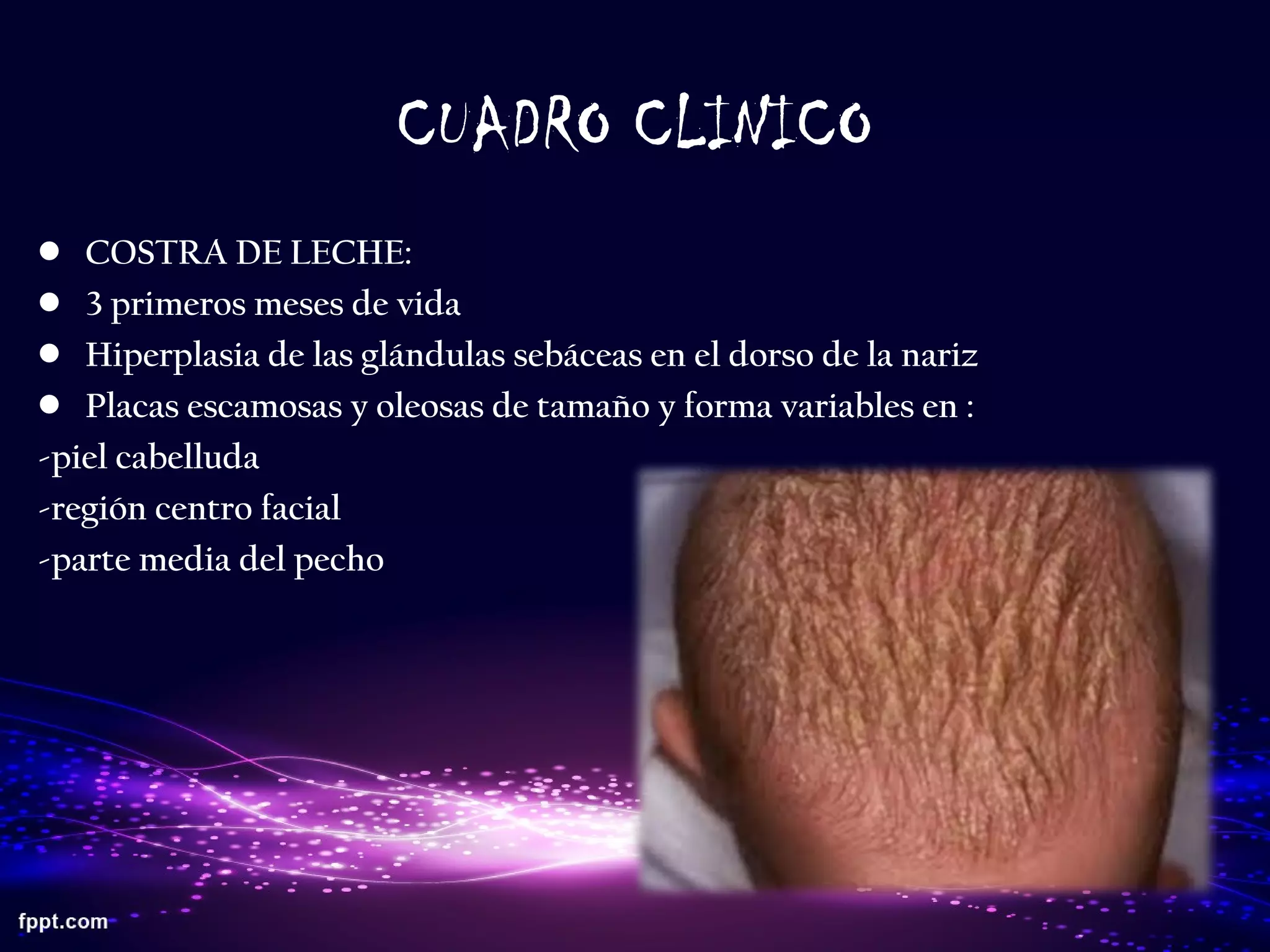 dermatitis seborreica, acne vulgar y rosacea | PPT